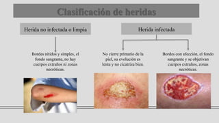 Clasificación de heridas y sus cura.pptx