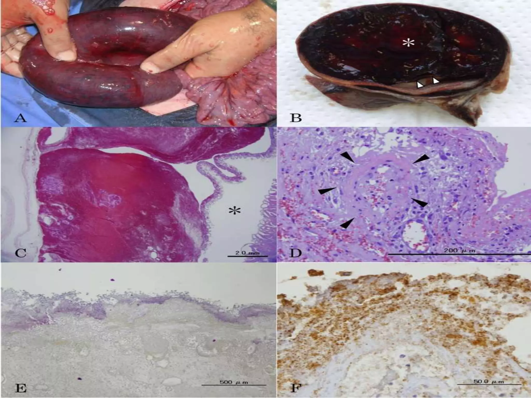 Jejunal hemorrhagic syndrome | PPTX