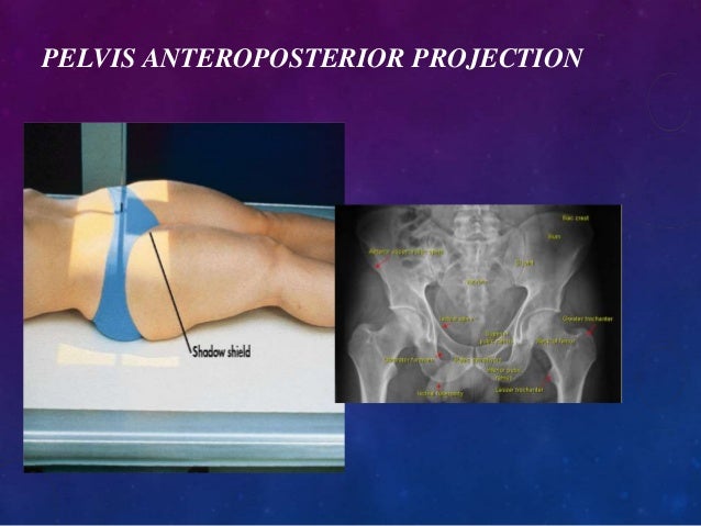 X-RAY PELVIS PROJECTIONS