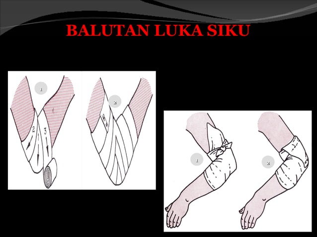 Jenis jenis balutan luka | PPT