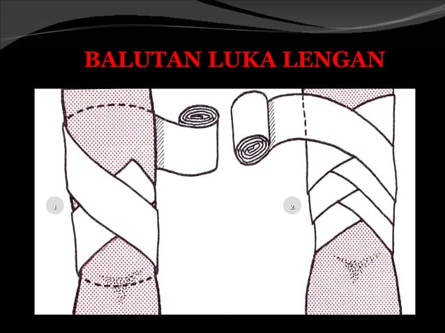 Jenis jenis balutan luka | PPT