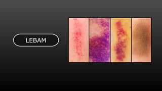 Jenis Kecederaan Ringan | PPTX