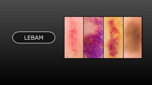 Jenis Kecederaan Ringan | PPTX