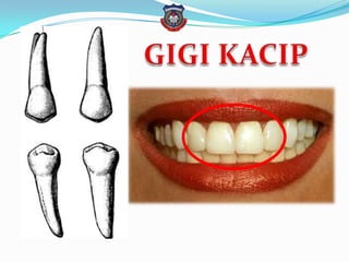 Jenis gigi | PPTX