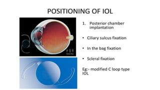 JENIS INTRAOCULAR LENS............................ | PPT