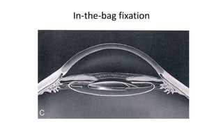 JENIS INTRAOCULAR LENS............................ | PPT