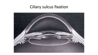 JENIS INTRAOCULAR LENS............................ | PPT