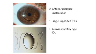 JENIS INTRAOCULAR LENS............................ | PPT