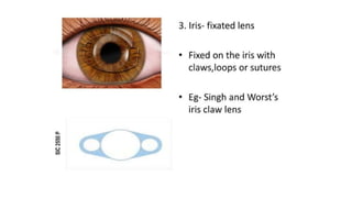 JENIS INTRAOCULAR LENS............................ | PPT