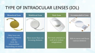 JENIS INTRAOCULAR LENS............................ | PPT