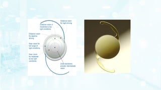 JENIS INTRAOCULAR LENS............................ | PPT