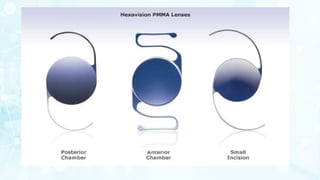 JENIS INTRAOCULAR LENS............................ | PPT