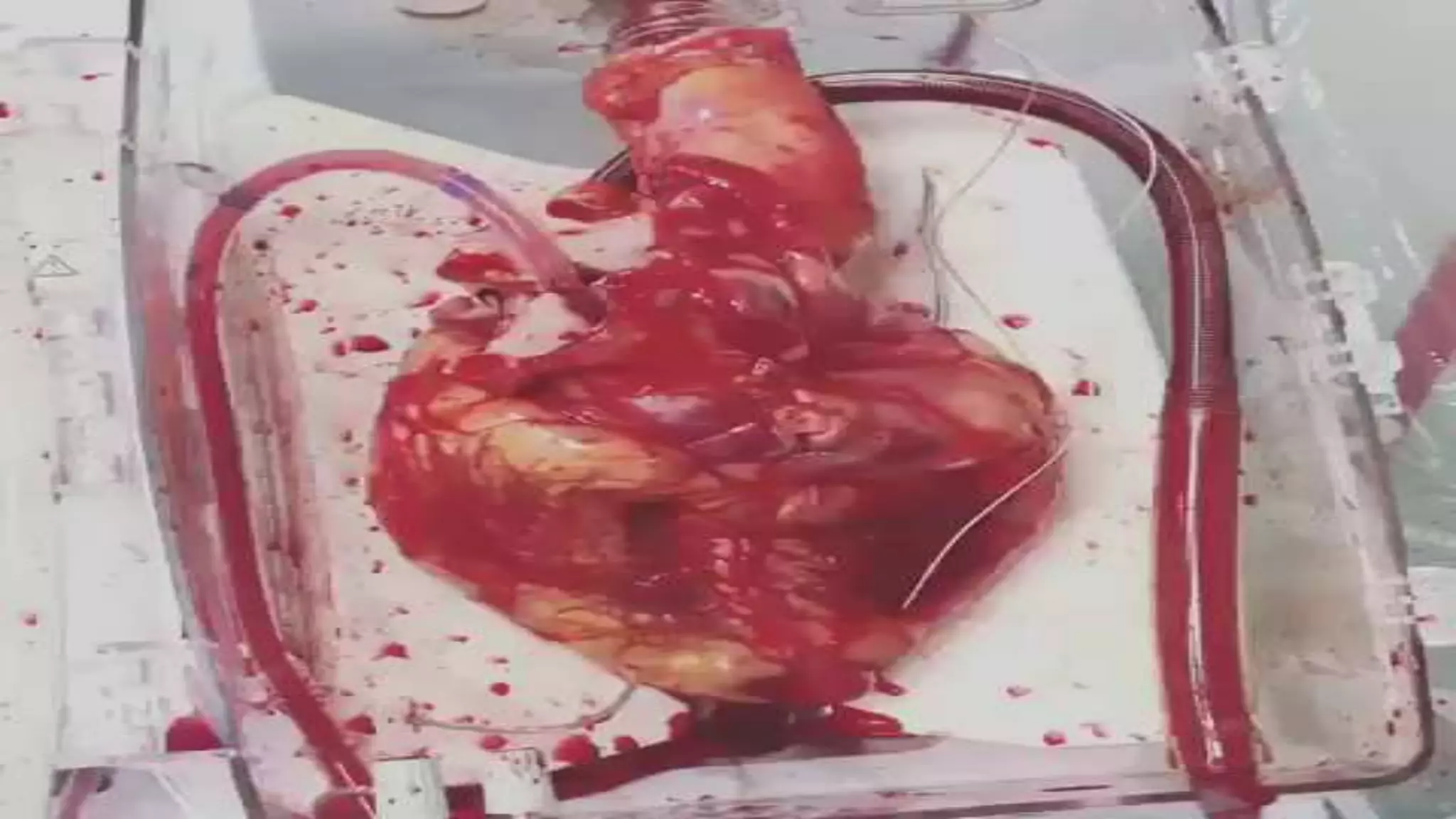 HEART TRANSPLANTATION SUGERY | PPTX