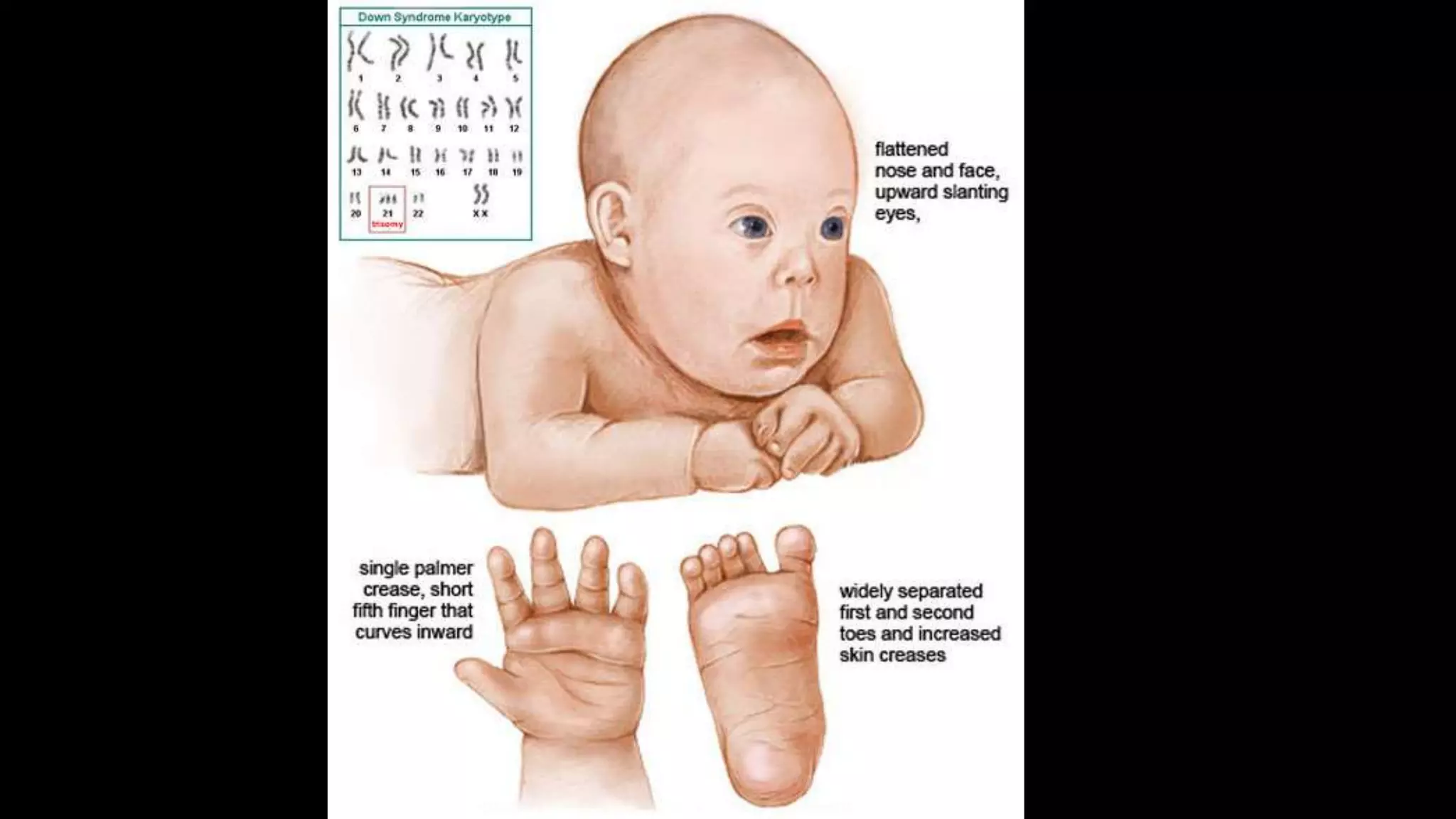 Jerome lejeune 2021-UN | PPT