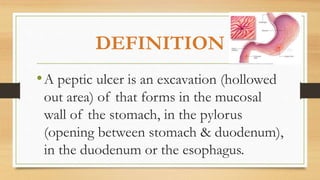 Peptic ulcer | PPT
