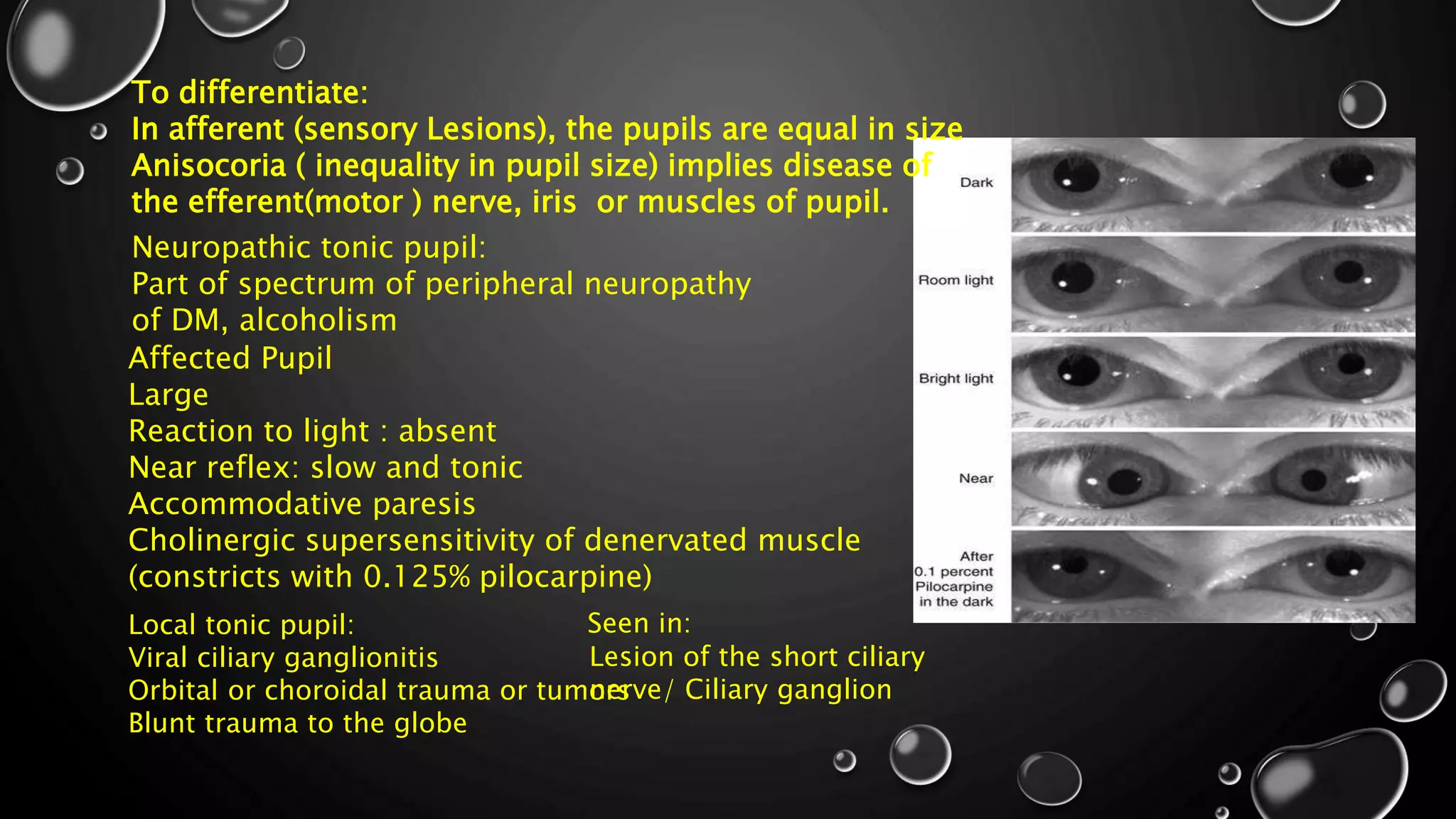 PUPIL AND ITS DISORDERS | PPTX