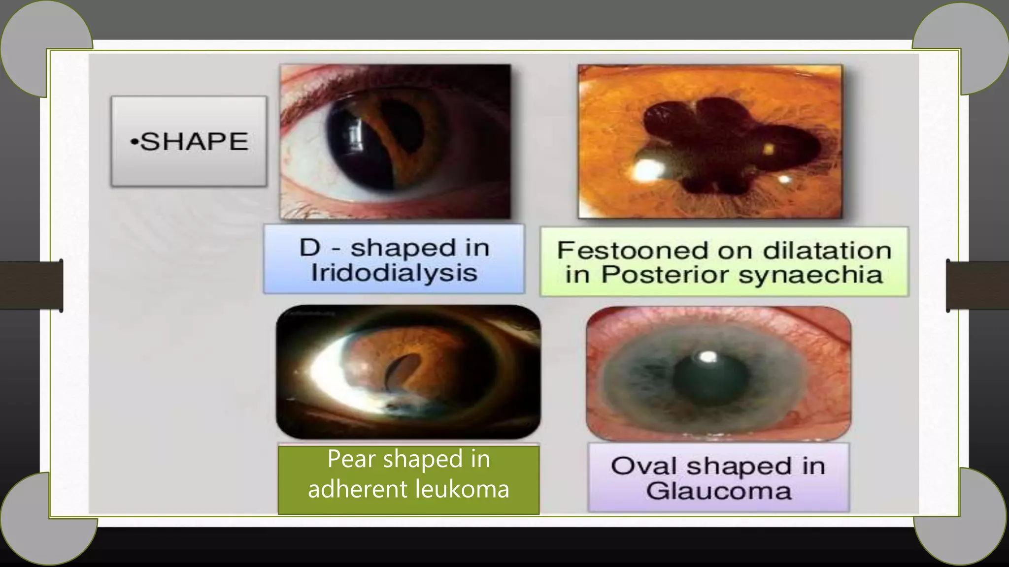 PUPIL AND ITS DISORDERS | PPT
