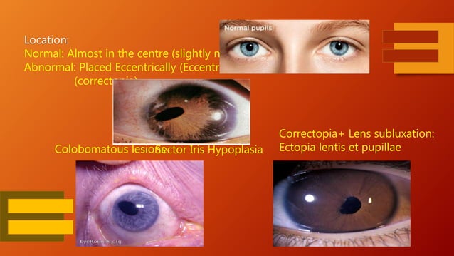 PUPIL AND ITS DISORDERS | PPT