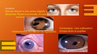 PUPIL AND ITS DISORDERS | PPT