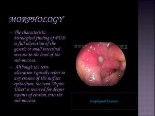 PEPTIC ULCER | PPTX