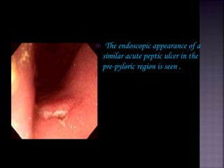 PEPTIC ULCER | PPT