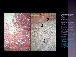 PEPTIC ULCER | PPTX
