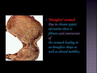 PEPTIC ULCER | PPTX