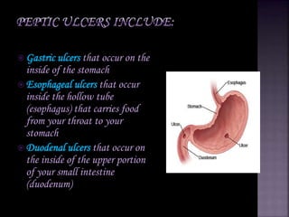 PEPTIC ULCER | PPTX