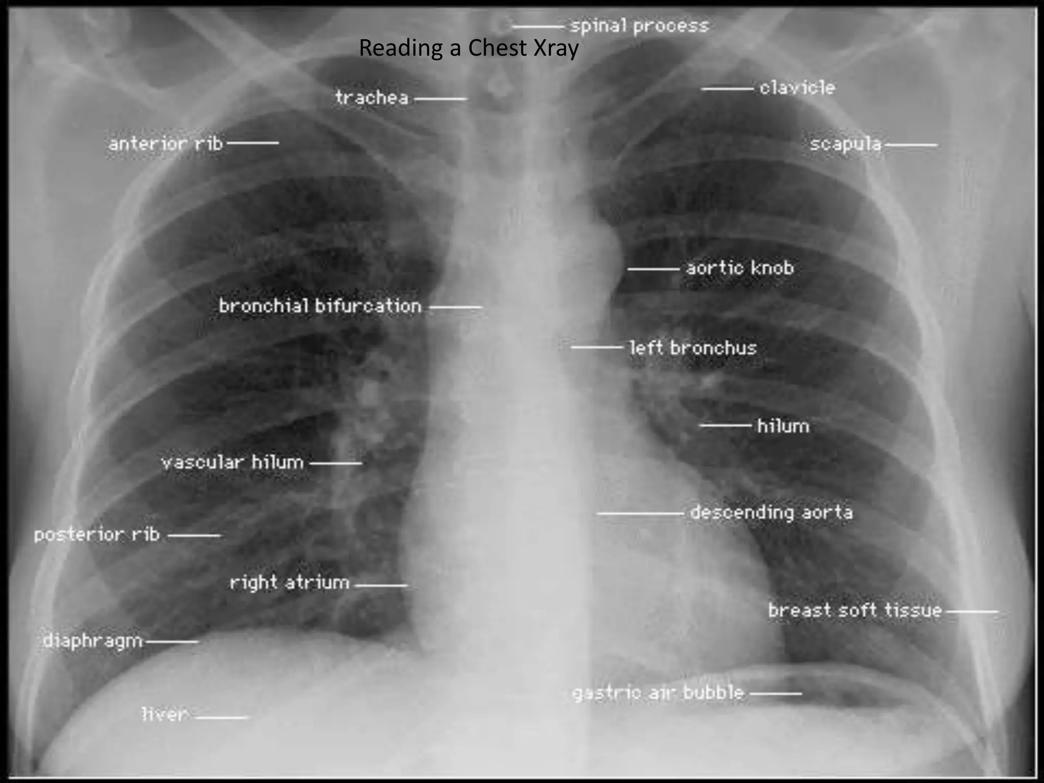 RADIOLOGY THORAX | PPTX