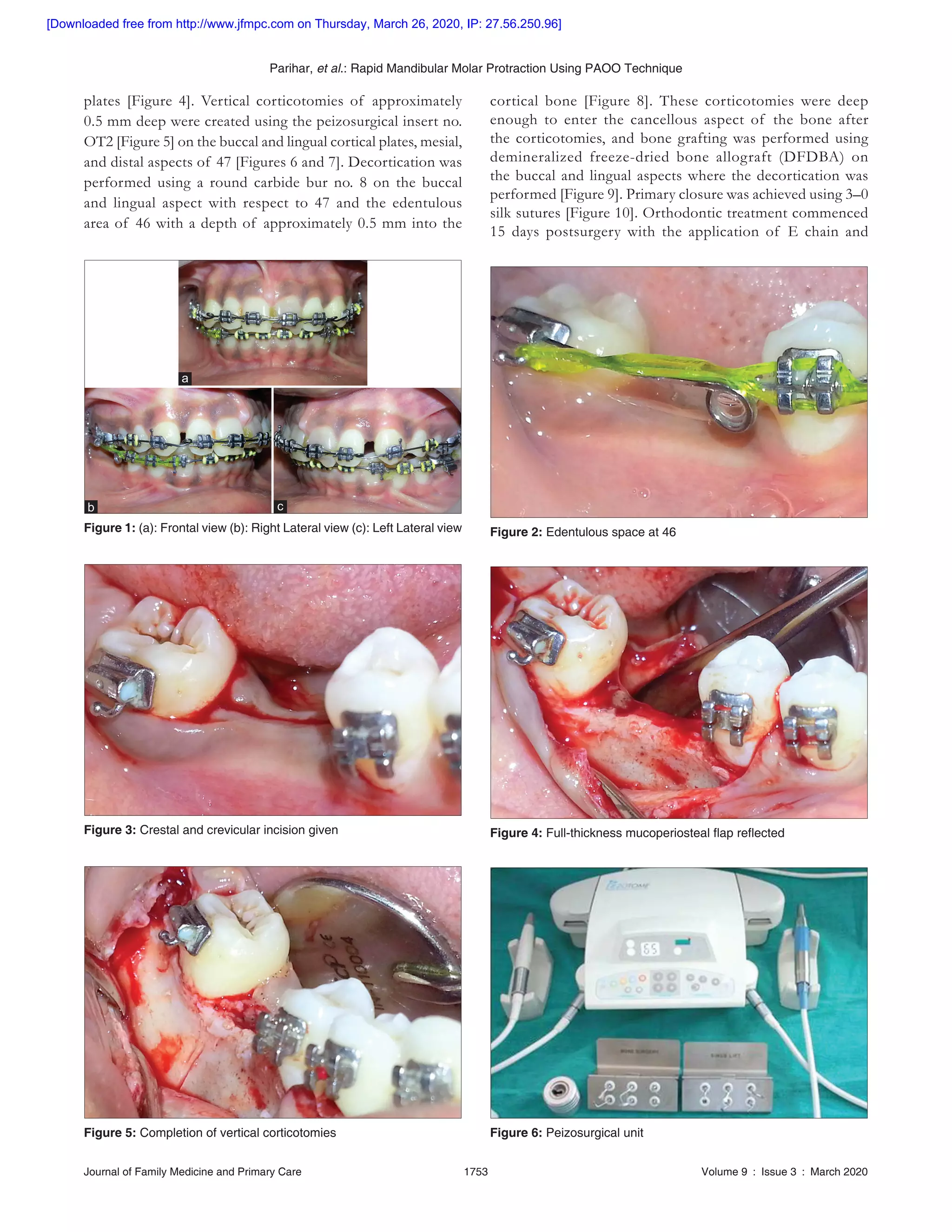 Periodontally accelerated osteogenic orthodontics: A perio-ortho ambidextrous perspective | PDF