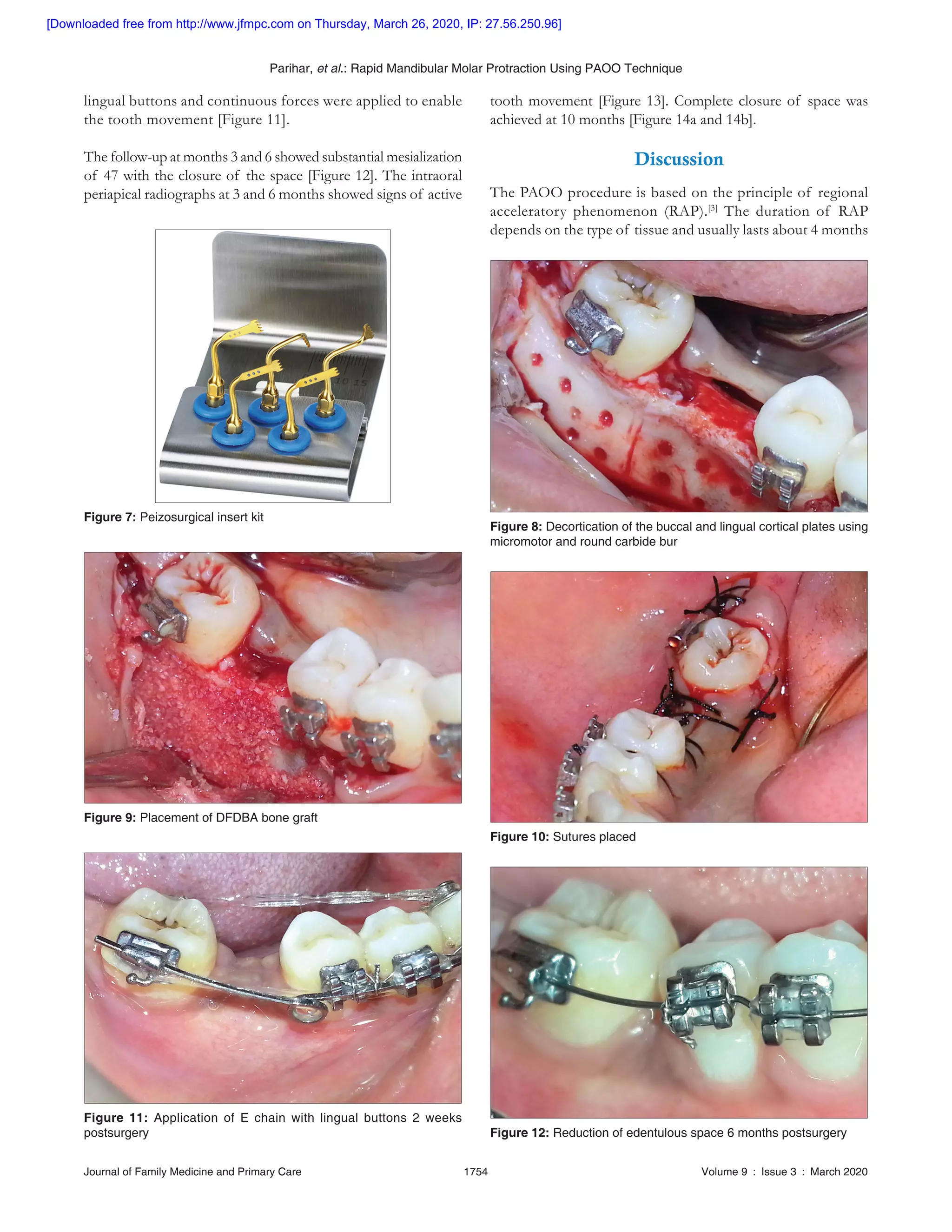 Periodontally accelerated osteogenic orthodontics: A perio-ortho ambidextrous perspective | PDF