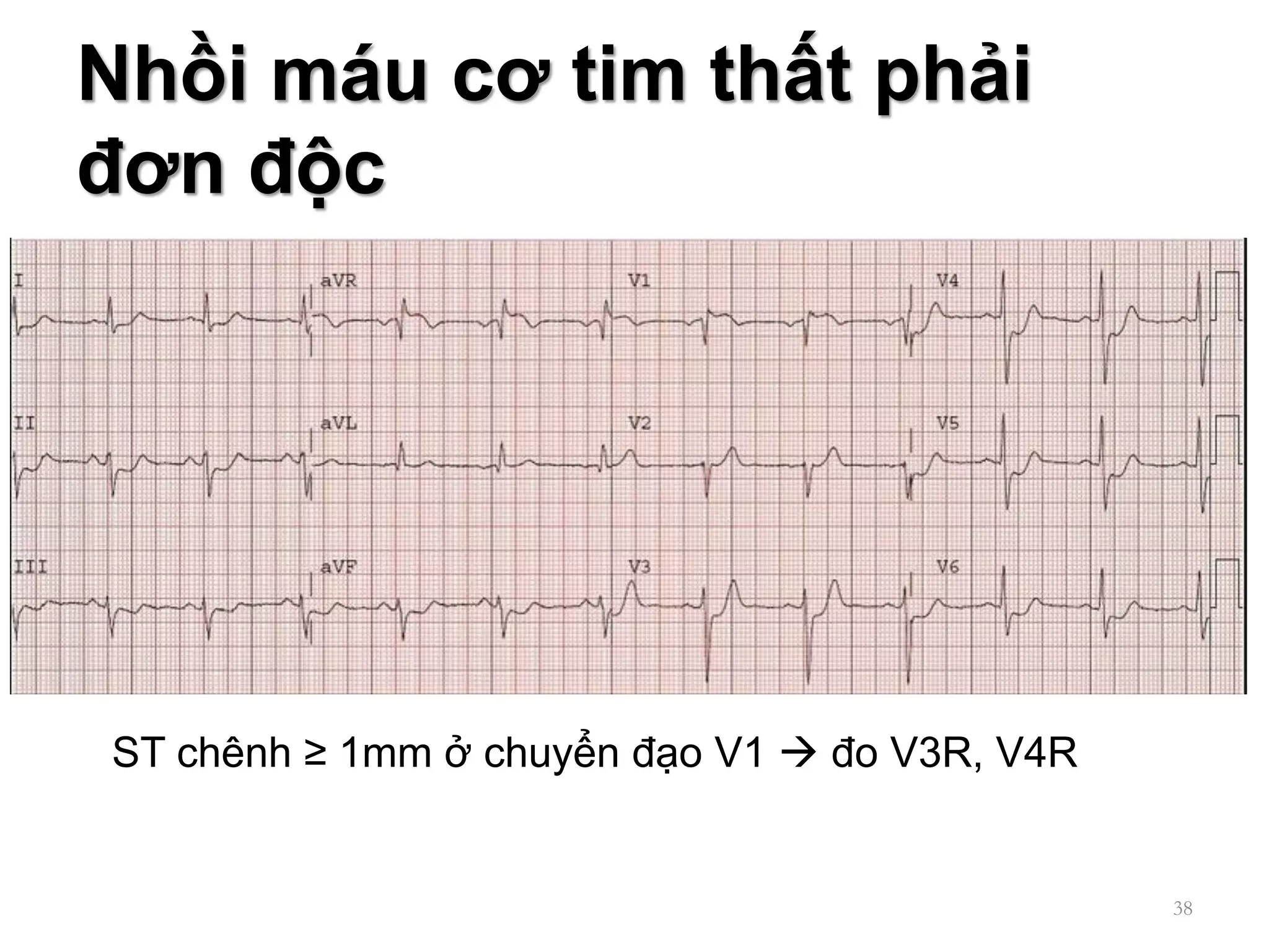 ECG TRONG BỆNH LÝ ĐỘNG MẠCH VÀNH | PDF