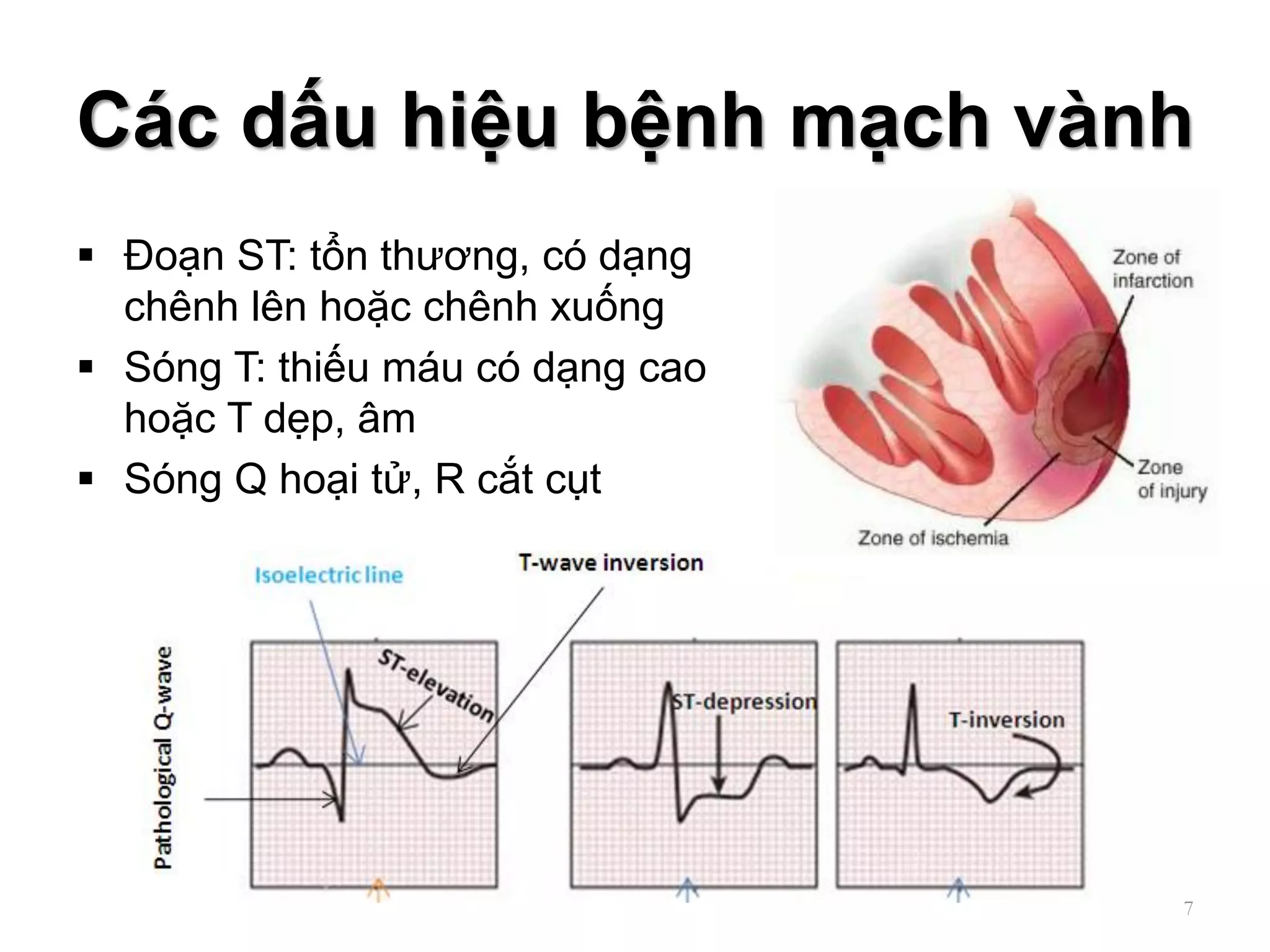 ECG TRONG BỆNH LÝ ĐỘNG MẠCH VÀNH | PDF