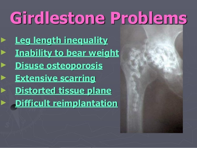 Antibiotic Cement Spacer for Infected Hip Joint Replacement (THR) Sur…