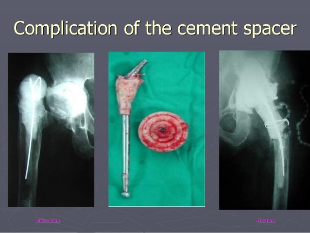Antibiotic Cement Spacer for Infected Hip Joint Replacement (THR) Sur…