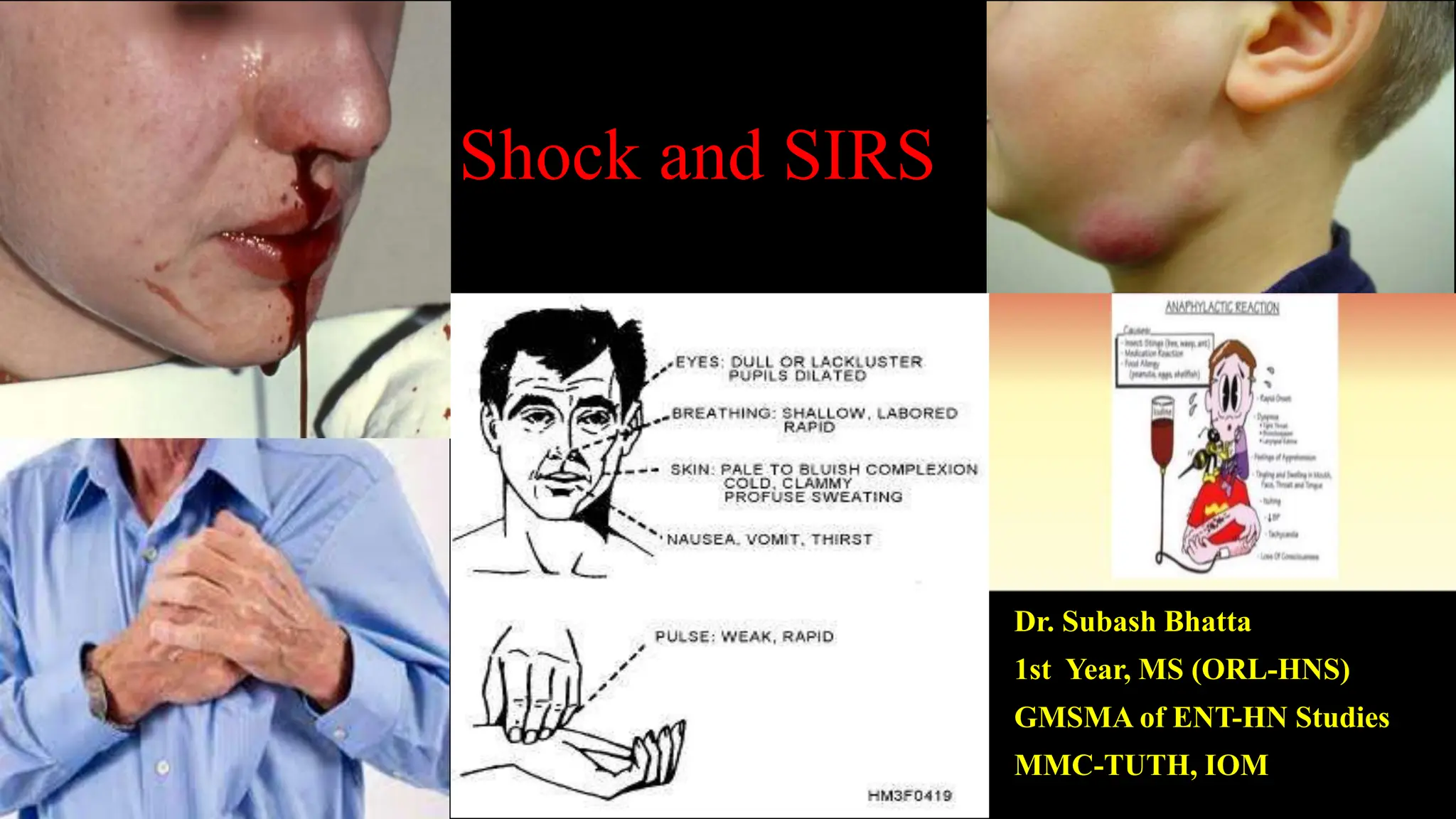 shock_and_sirs in basic otolaryngology.pptx