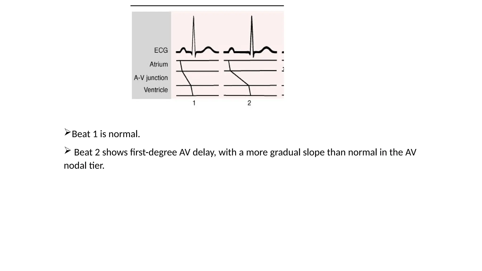 ecg on BRADYCARDIA sinus node dysfunction av block | PPTX