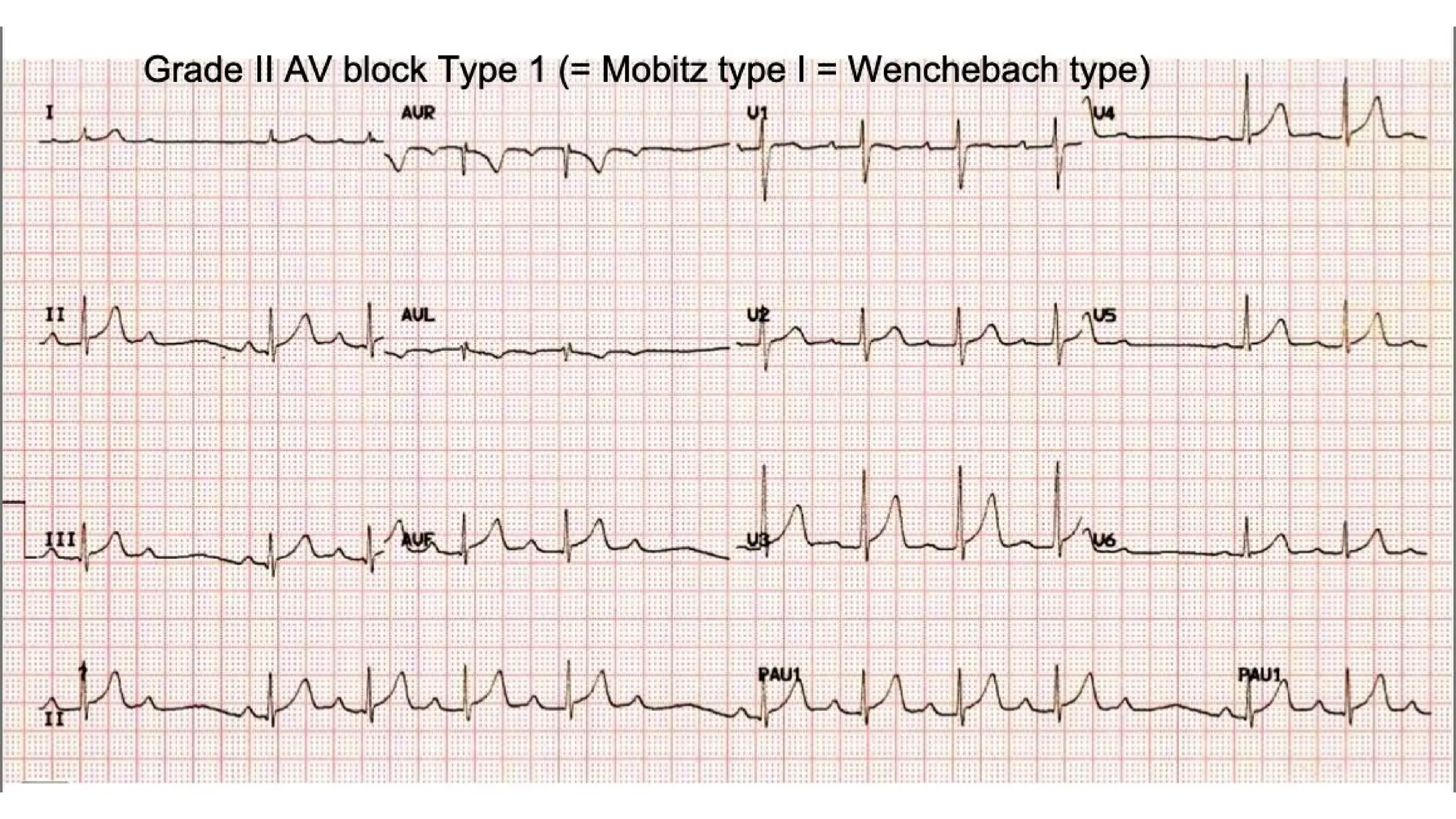 ecg on BRADYCARDIA sinus node dysfunction av block | PPTX