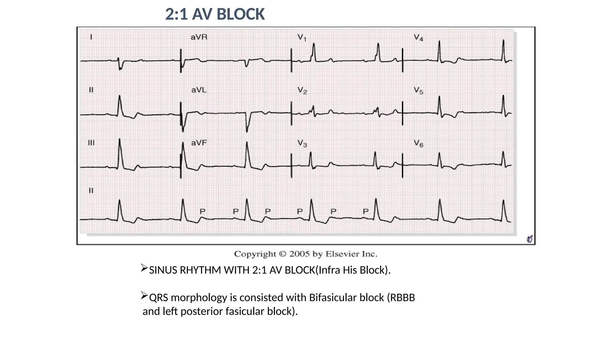 ecg on BRADYCARDIA sinus node dysfunction av block | PPTX