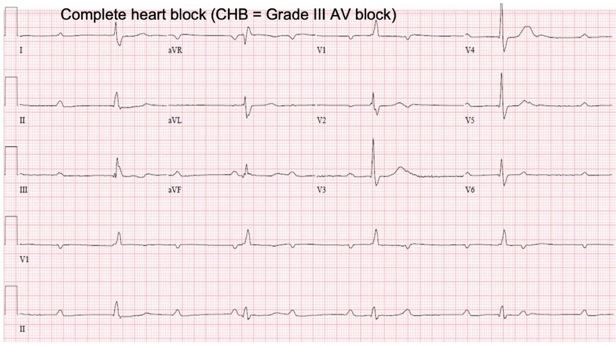 ecg on BRADYCARDIA sinus node dysfunction av block | PPTX