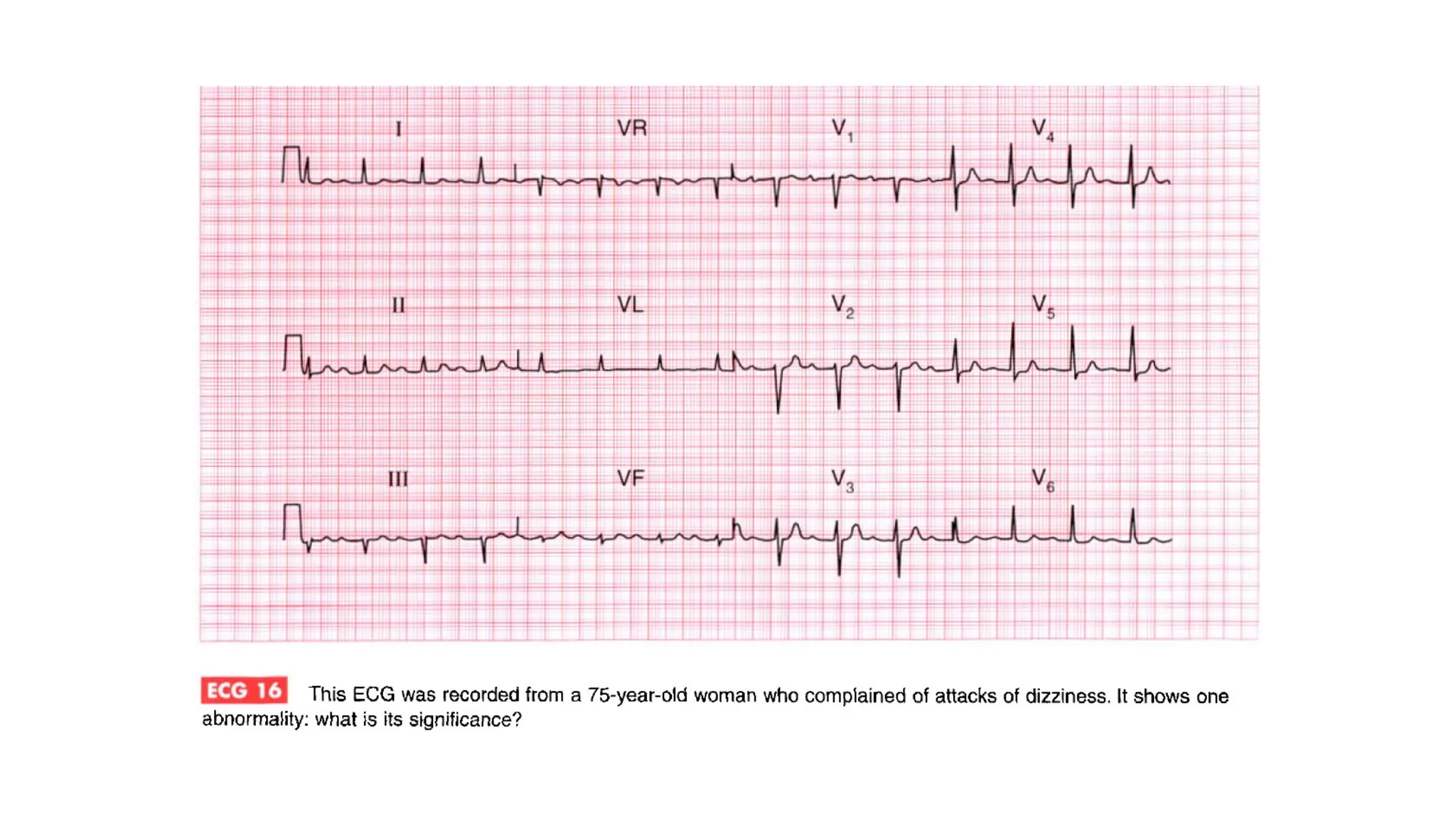 ecg on BRADYCARDIA sinus node dysfunction av block | PPTX