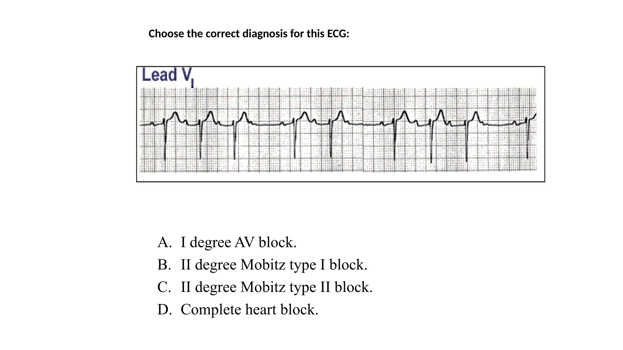 ecg on BRADYCARDIA sinus node dysfunction av block | PPTX