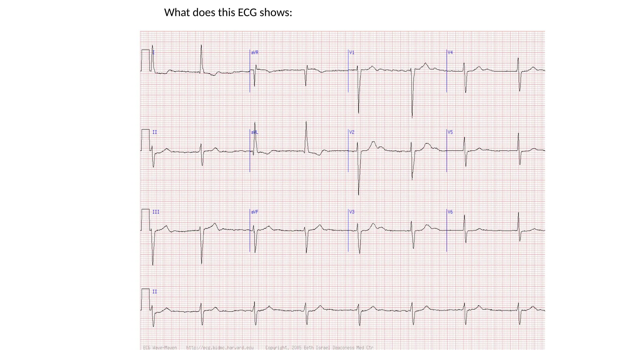 ecg on BRADYCARDIA sinus node dysfunction av block | PPTX
