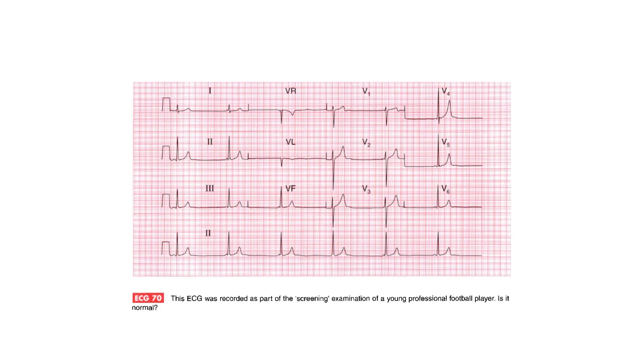 ecg on BRADYCARDIA sinus node dysfunction av block | PPTX