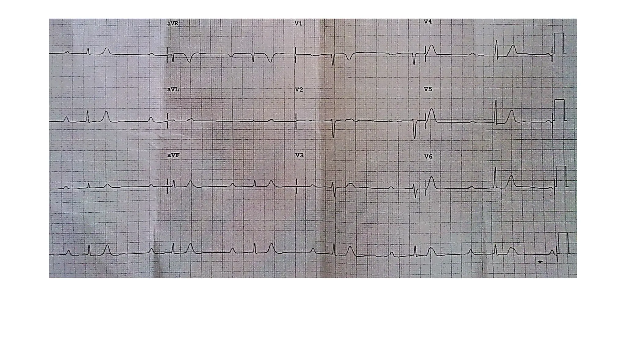 ecg on BRADYCARDIA sinus node dysfunction av block | PPTX