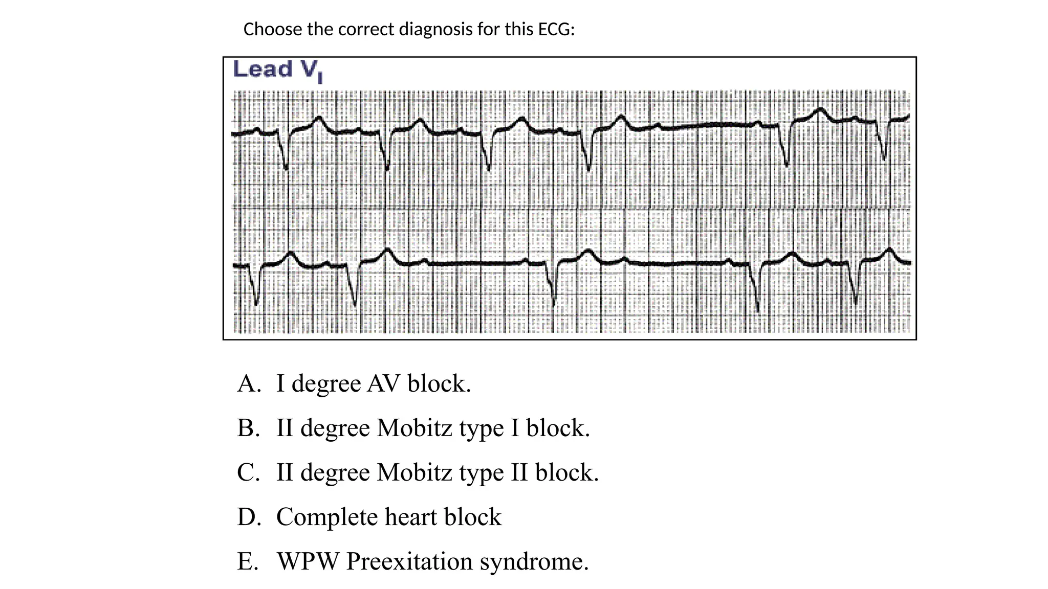 ecg on BRADYCARDIA sinus node dysfunction av block | PPTX