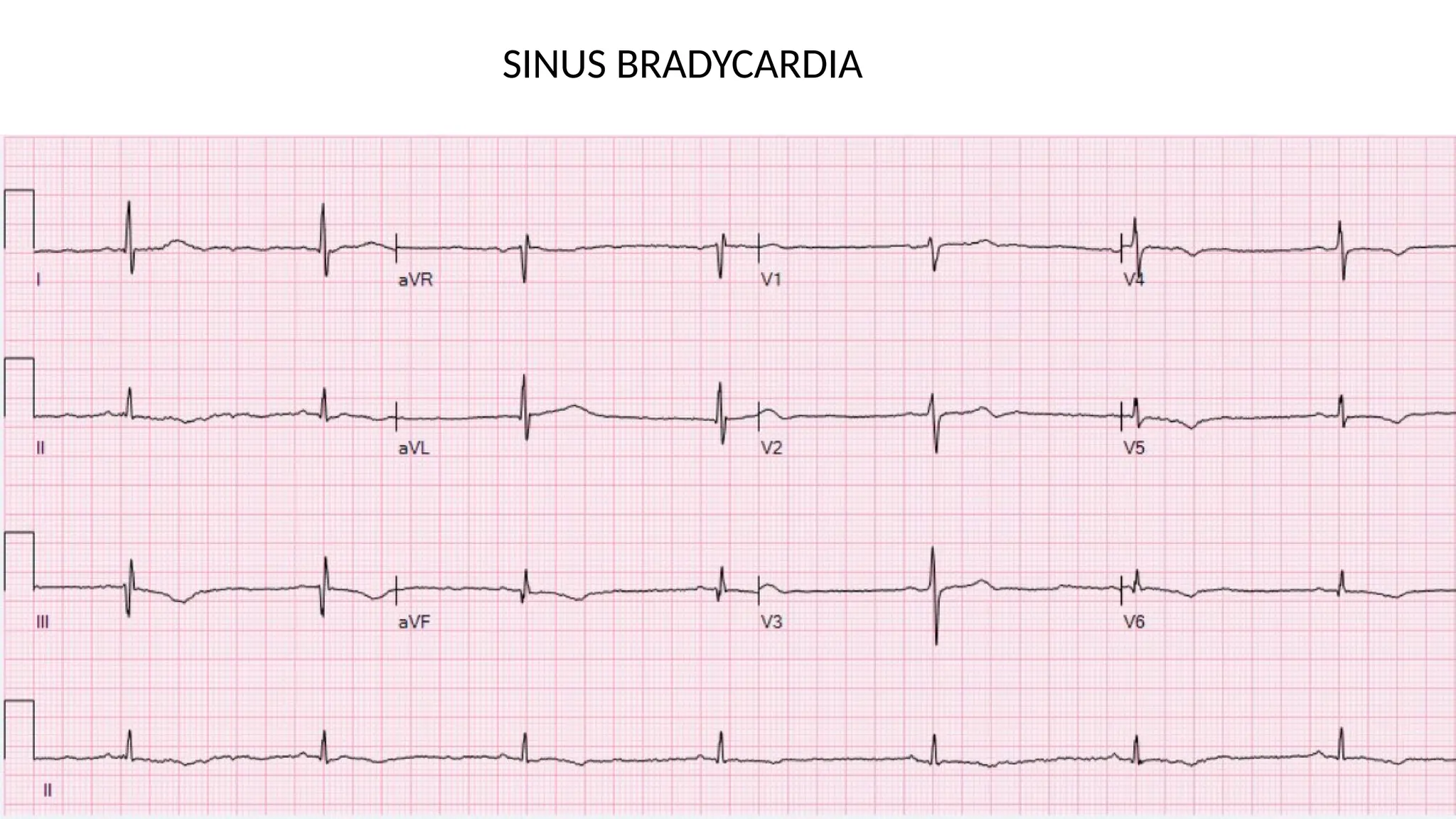 ecg on BRADYCARDIA sinus node dysfunction av block | PPTX