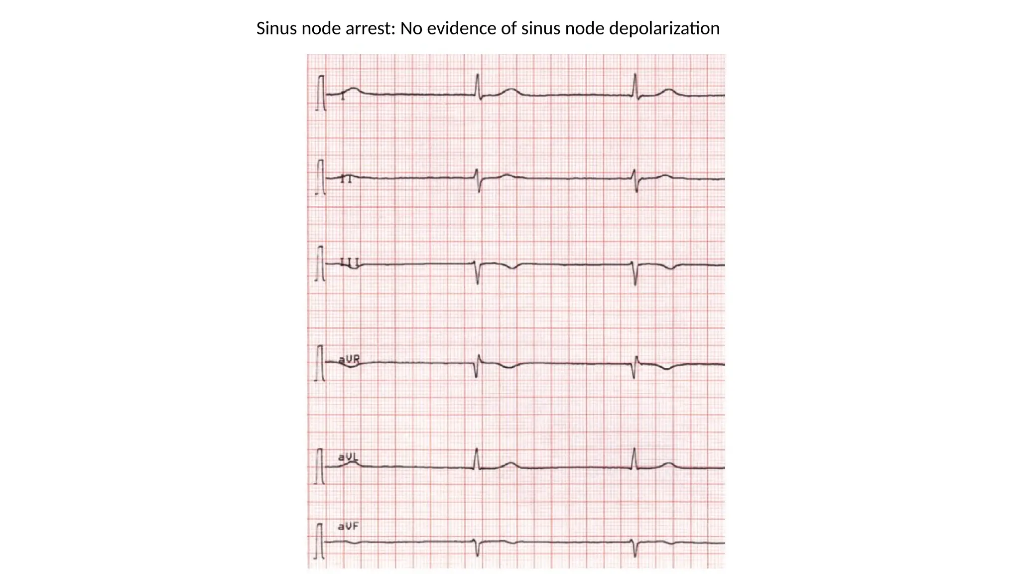 ecg on BRADYCARDIA sinus node dysfunction av block | PPTX