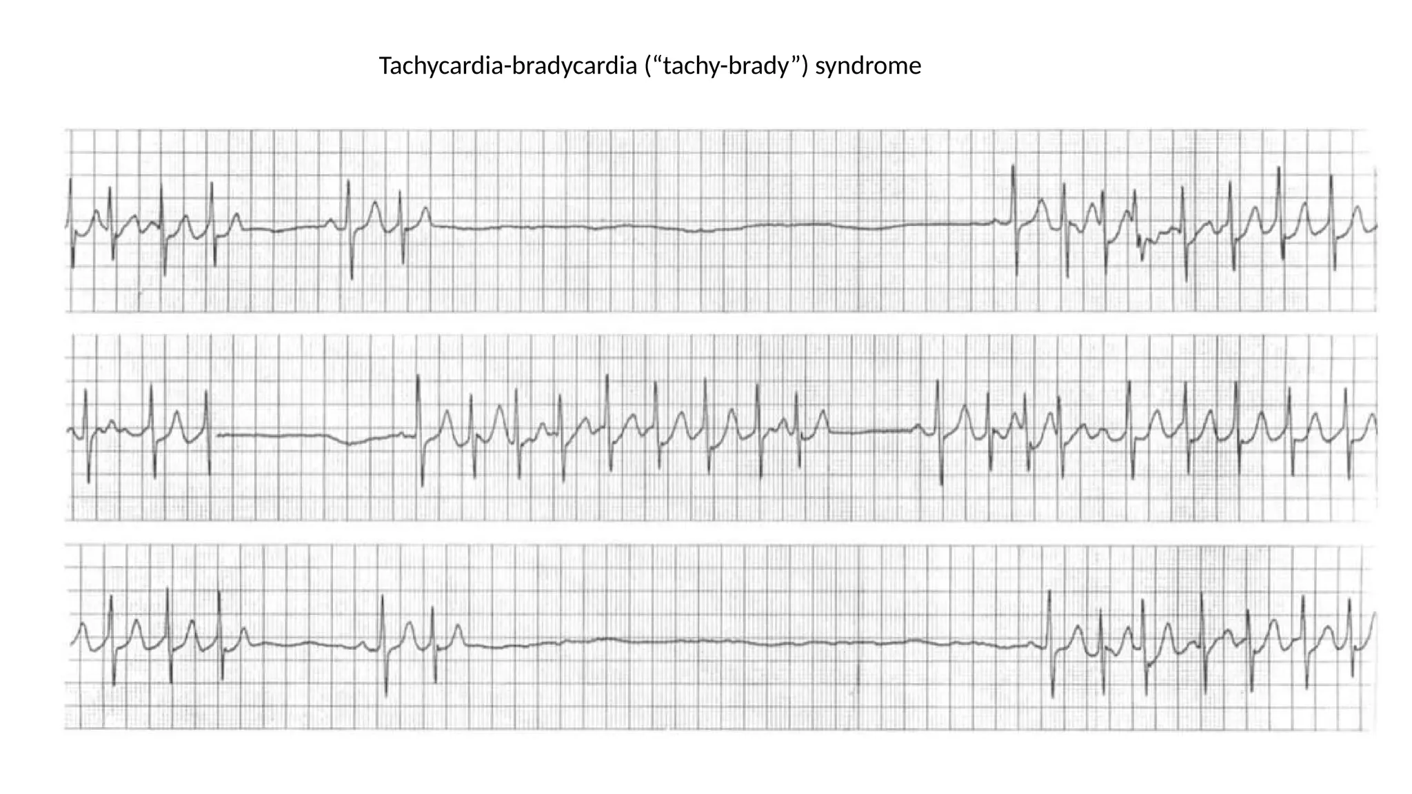 ecg on BRADYCARDIA sinus node dysfunction av block | PPTX