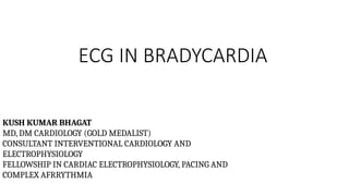 ecg on BRADYCARDIA sinus node dysfunction av block | PPTX
